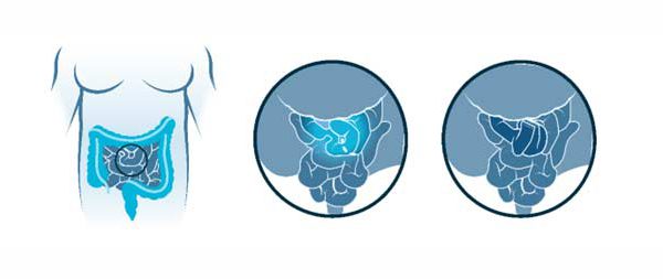 Small Intestine Surgery - Healing Hands Health Care Centre